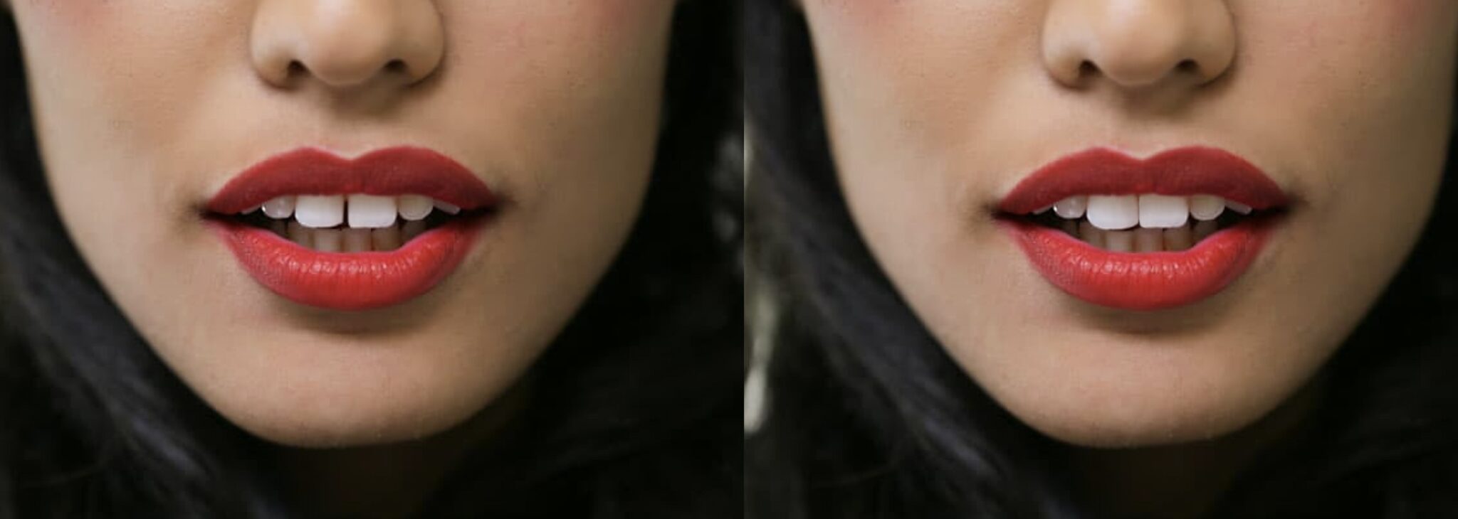 What is Composite Restoration?