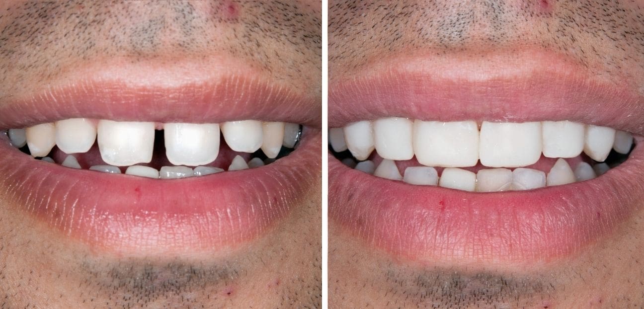 Dental Diastema Treatment with Composite Restoration - Cost-Process